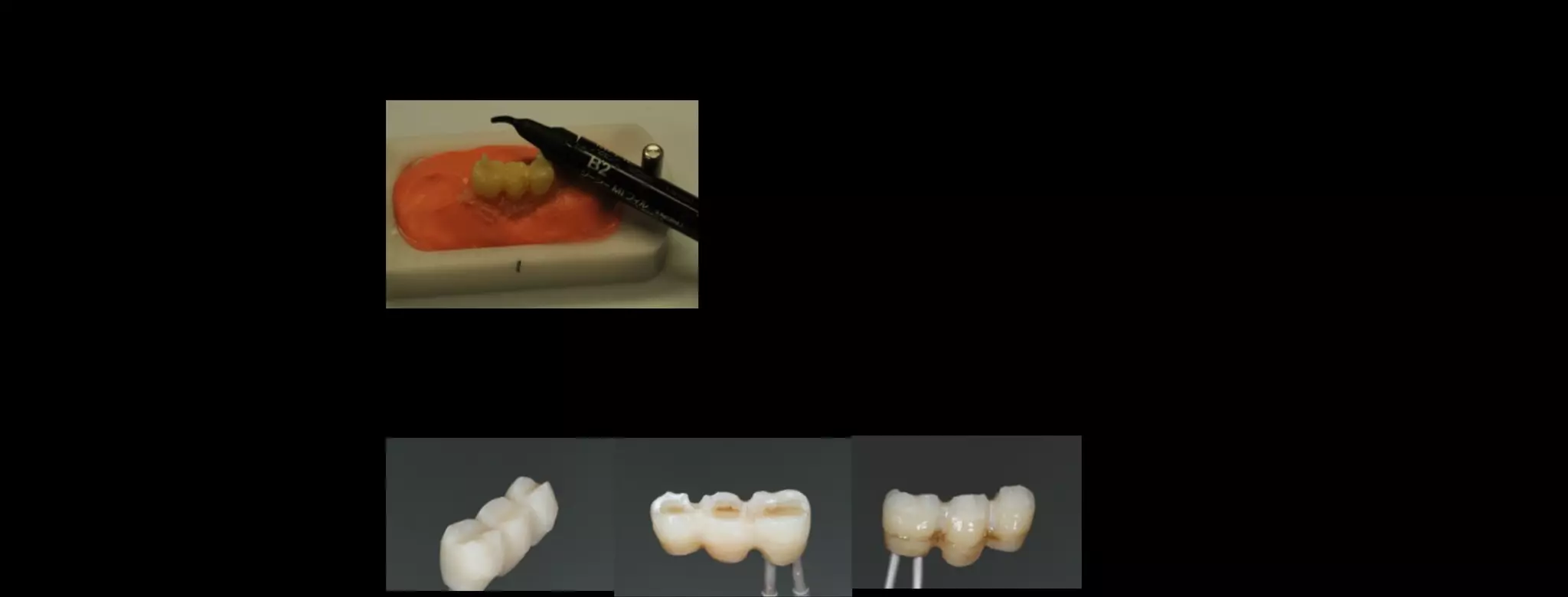 Direct Reconstructions with Syringable Flowable Resin Composite (G ...