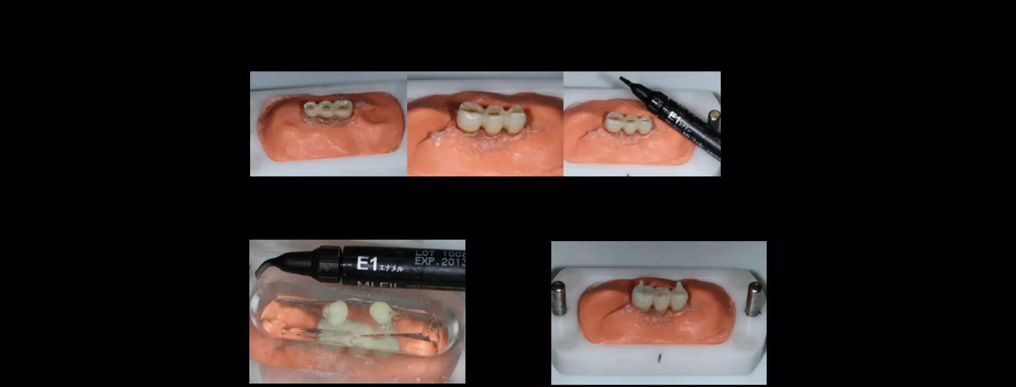 Direct Reconstructions with Syringable Flowable Resin Composite (G ...