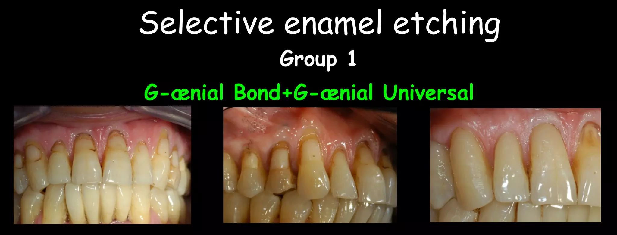 Direct Reconstructions with Syringable Flowable Resin Composite (G ...