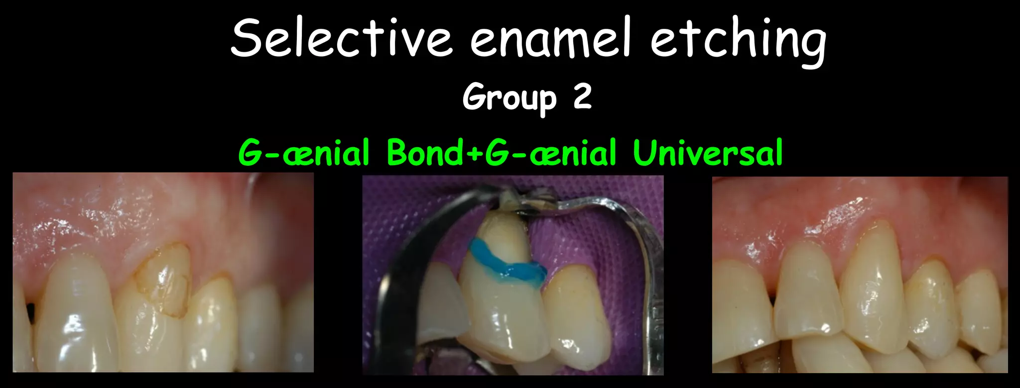 Direct Reconstructions with Syringable Flowable Resin Composite (G ...
