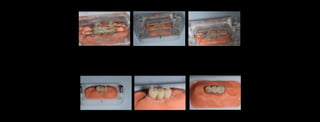 Direct Reconstructions with Syringable Flowable Resin Composite (G ...