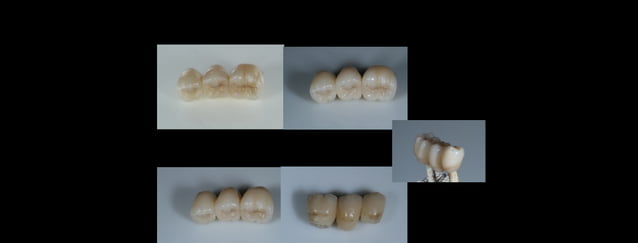 Direct Reconstructions with Syringable Flowable Resin Composite (G ...