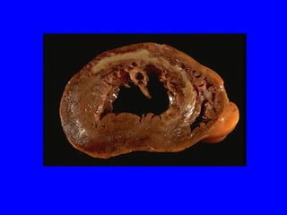 Damaged myocardium | PPT