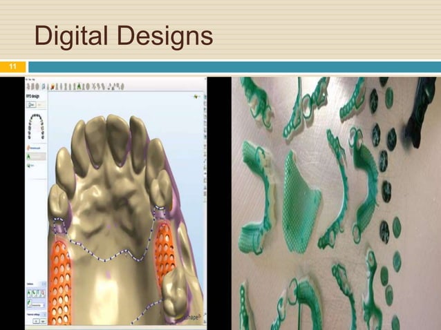 Steps of Fabrication of Removable Partial Denture | PPTX | Oral care ...