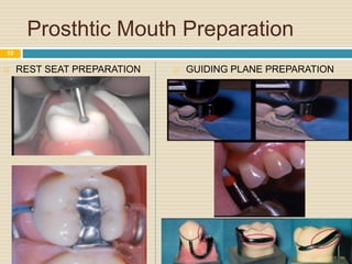 Steps of Fabrication of Removable Partial Denture | PPTX