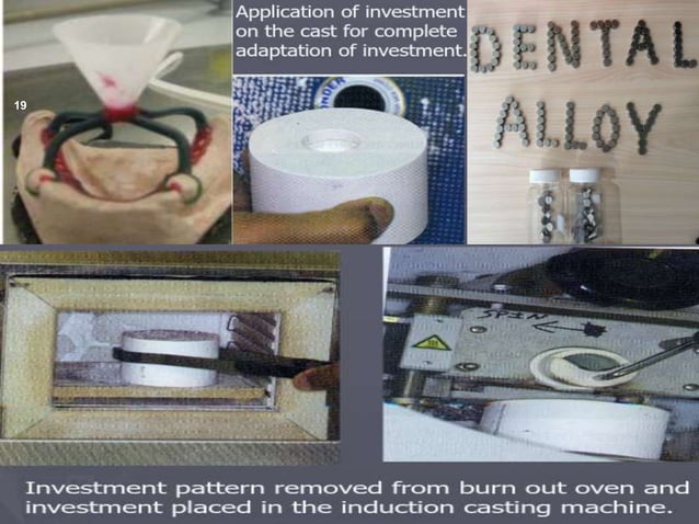 Steps of Fabrication of Removable Partial Denture | PPTX | Oral care ...