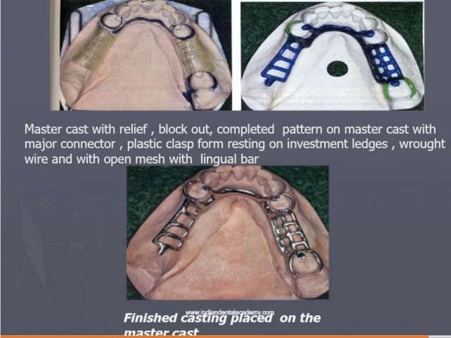 Steps of Fabrication of Removable Partial Denture | PPTX | Oral care ...