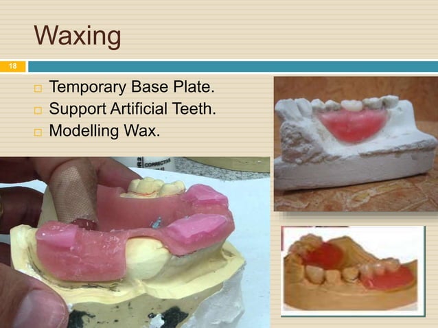 Steps of Fabrication of Removable Partial Denture | PPTX | Oral care ...
