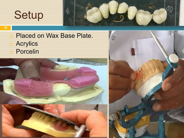 Steps of Fabrication of Removable Partial Denture | PPTX | Oral care ...