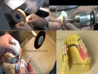Steps of Fabrication of Removable Partial Denture | PPTX