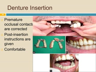 Steps of Fabrication of Removable Partial Denture | PPTX