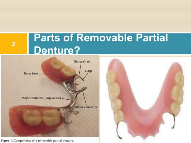 Steps of Fabrication of Removable Partial Denture | PPTX | Oral care ...