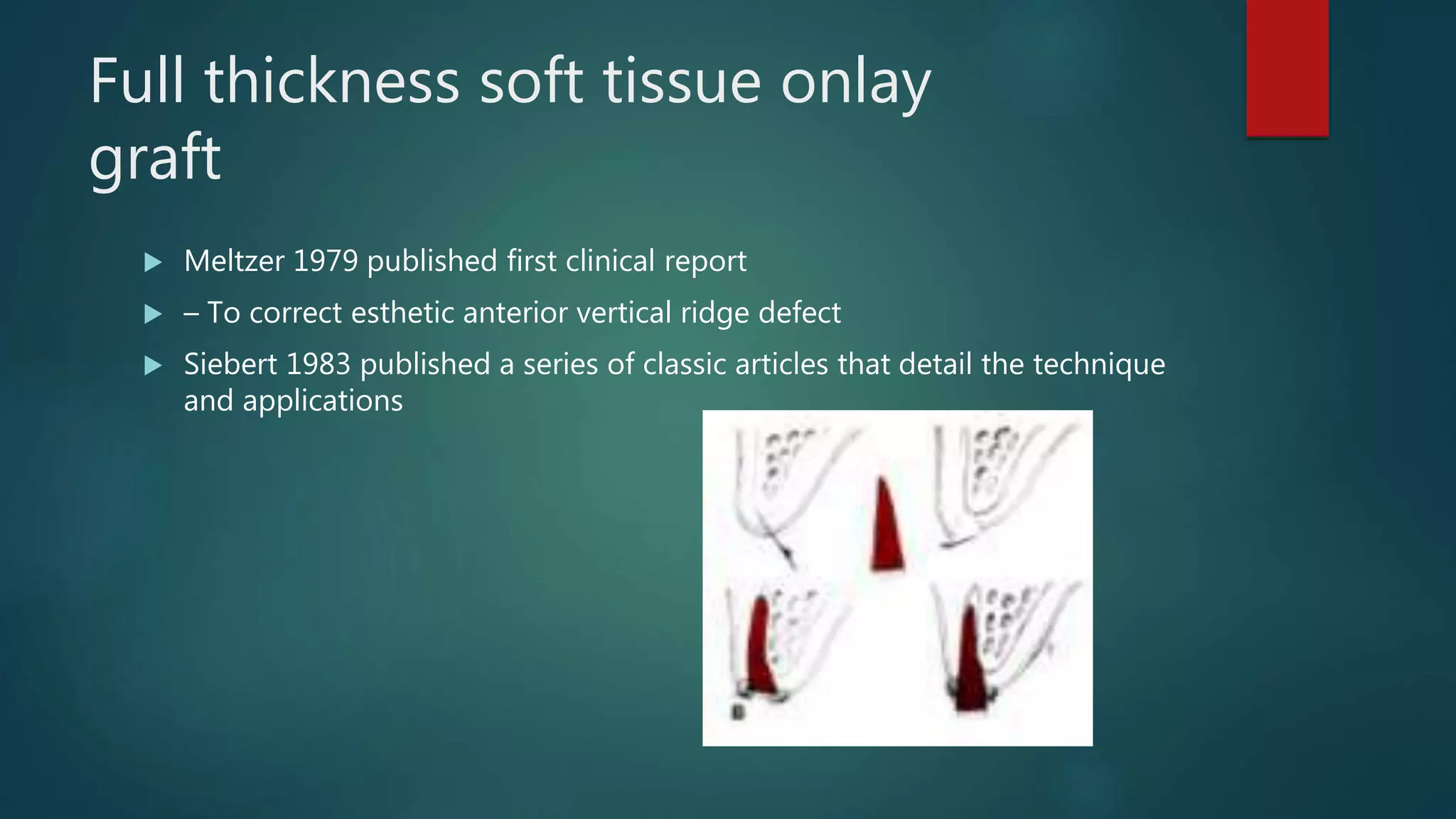 Ridge augmentation - Dr. Kinjal ghelani | PPTX