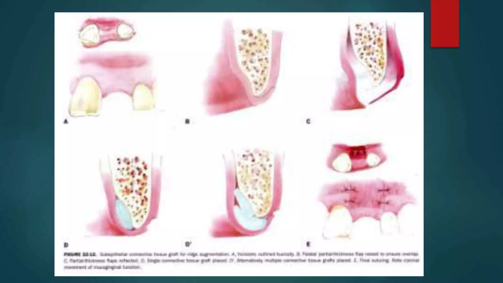 Ridge augmentation - Dr. Kinjal ghelani | PPTX