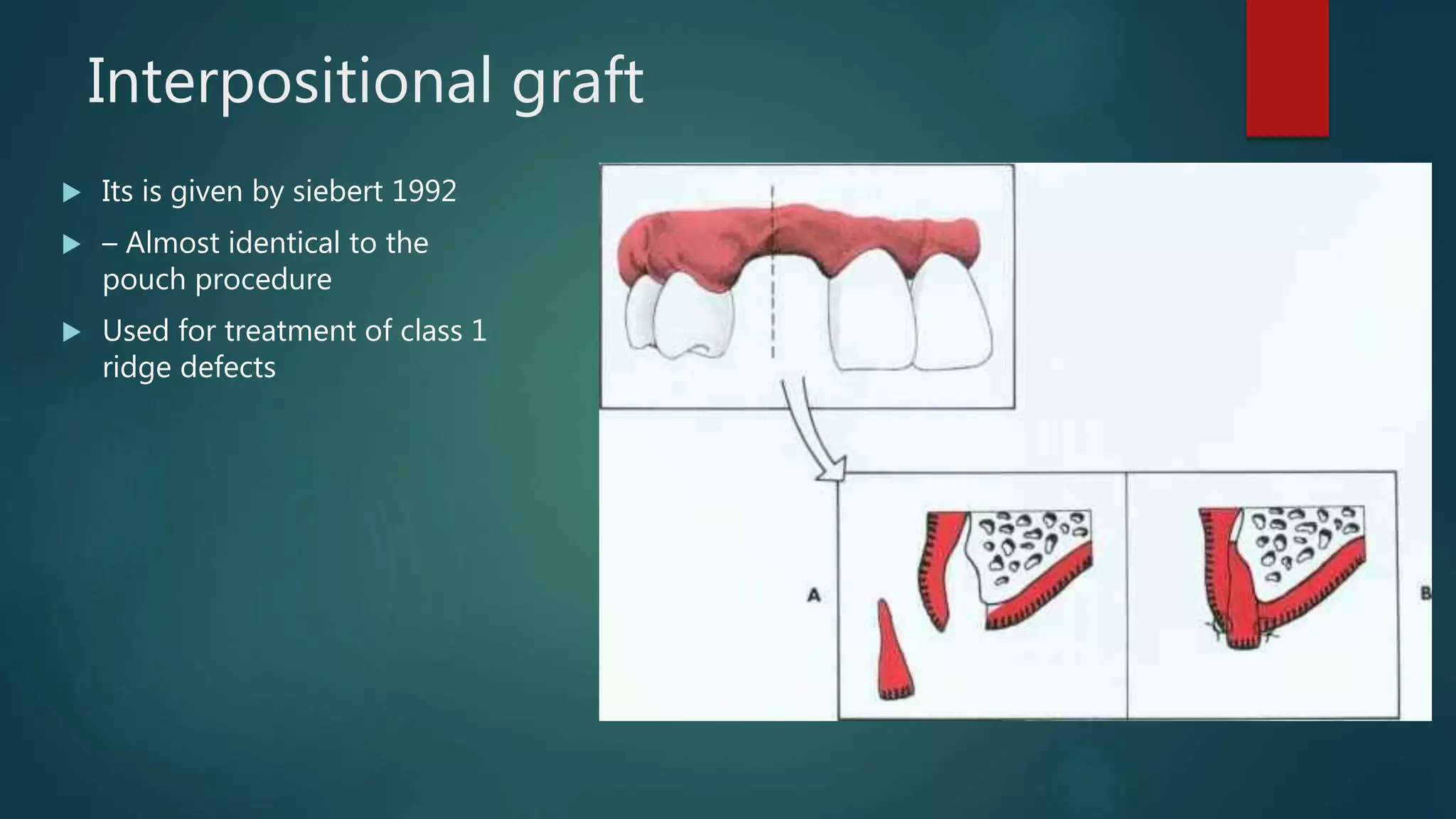 Ridge augmentation - Dr. Kinjal ghelani | PPTX