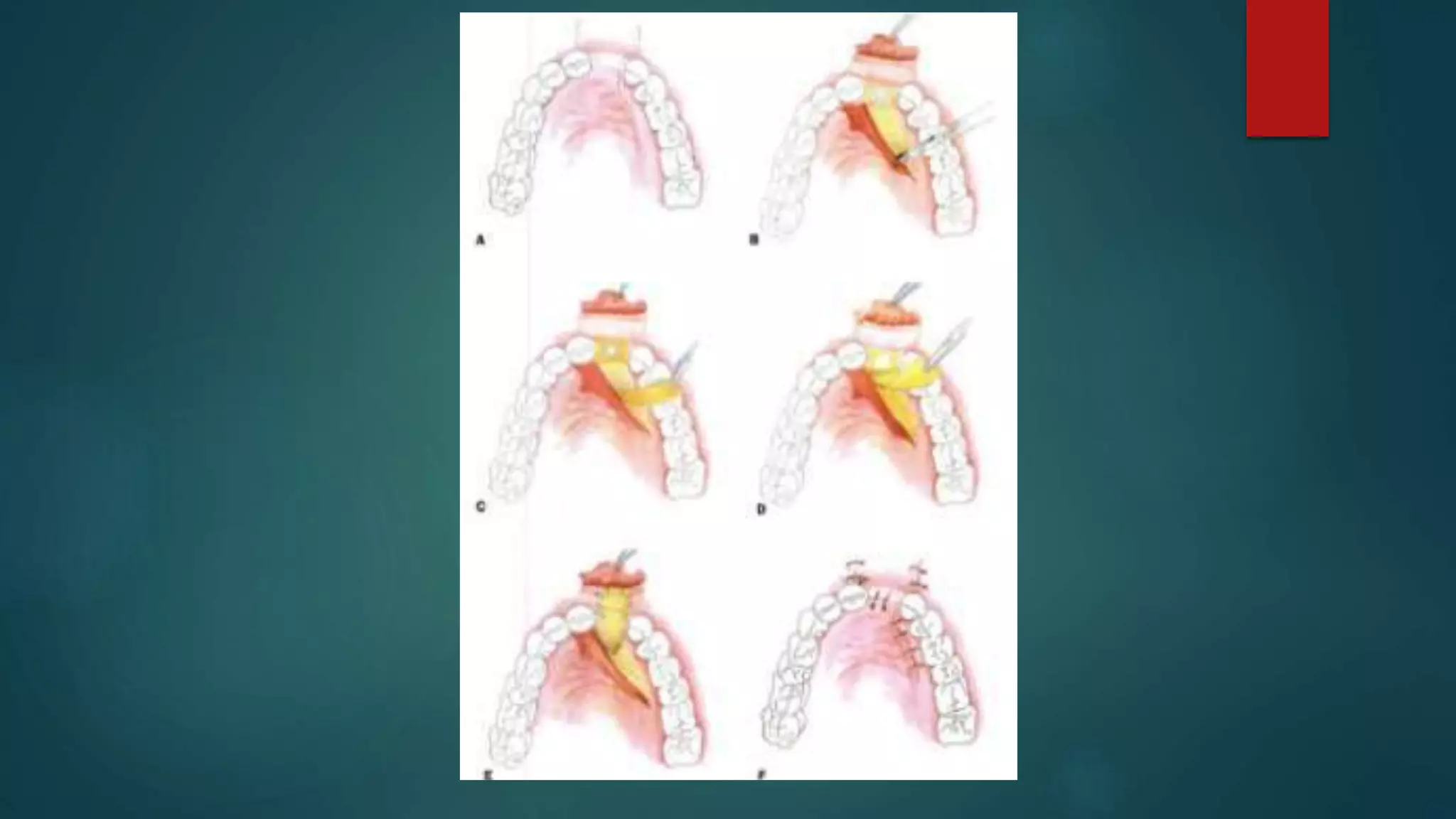 Ridge augmentation - Dr. Kinjal ghelani | PPTX