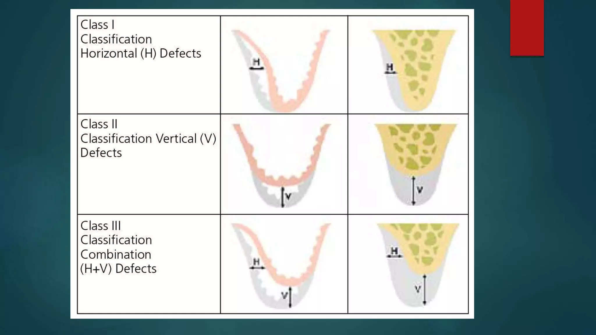 Ridge augmentation - Dr. Kinjal ghelani | PPTX