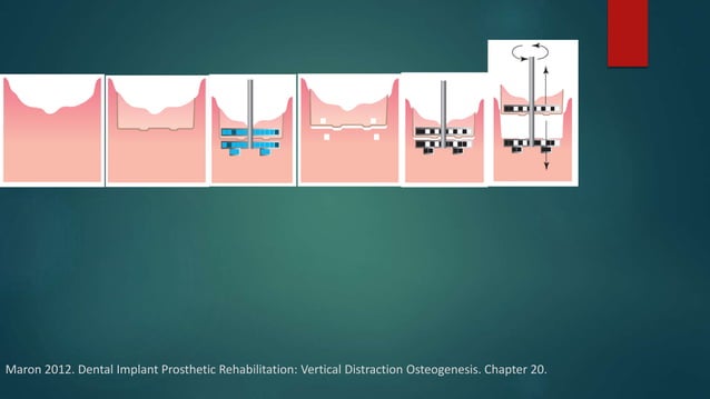 Ridge augmentation - Dr. Kinjal ghelani | PPTX