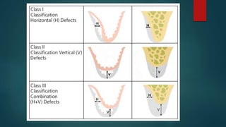 Ridge augmentation - Dr. Kinjal ghelani | PPTX