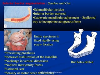 Ridge augmentation procedures /orthodontic courses by Indian dental ...