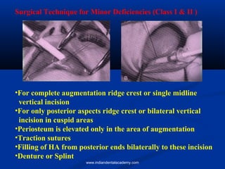 Ridge augmentation procedures /orthodontic courses by Indian dental ...