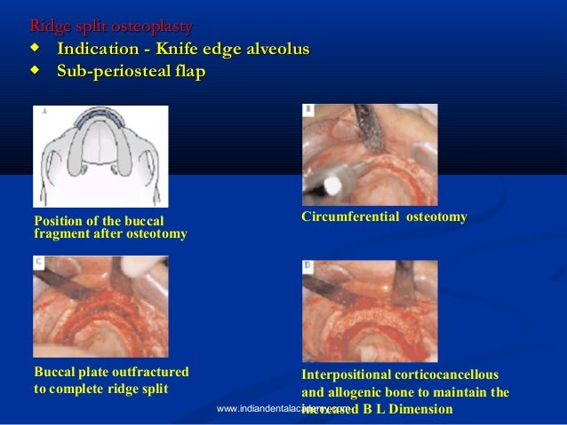 Ridge augmentation procedures /orthodontic courses by Indian dental