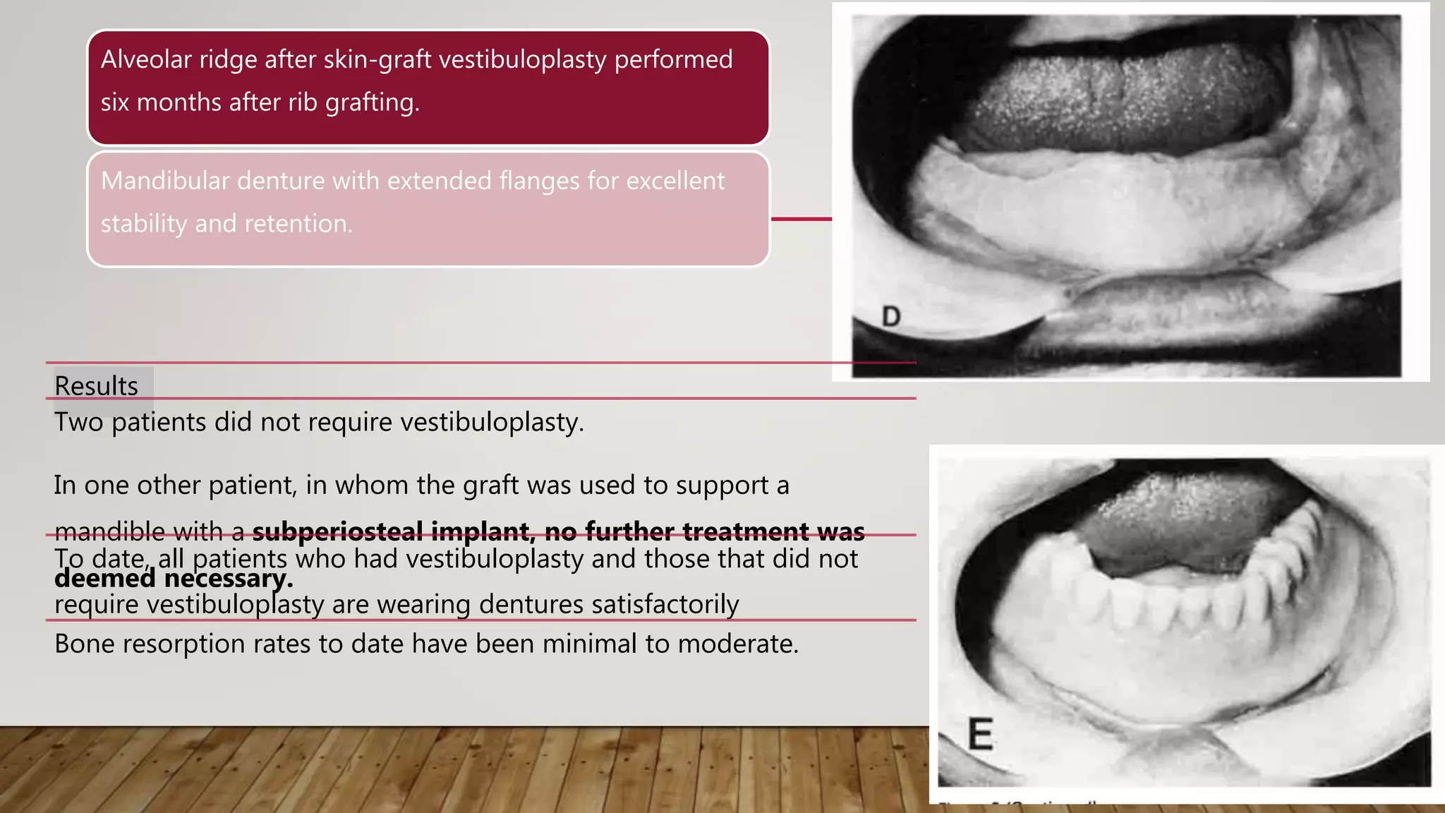 Ridge augmentation seminar | PPTX