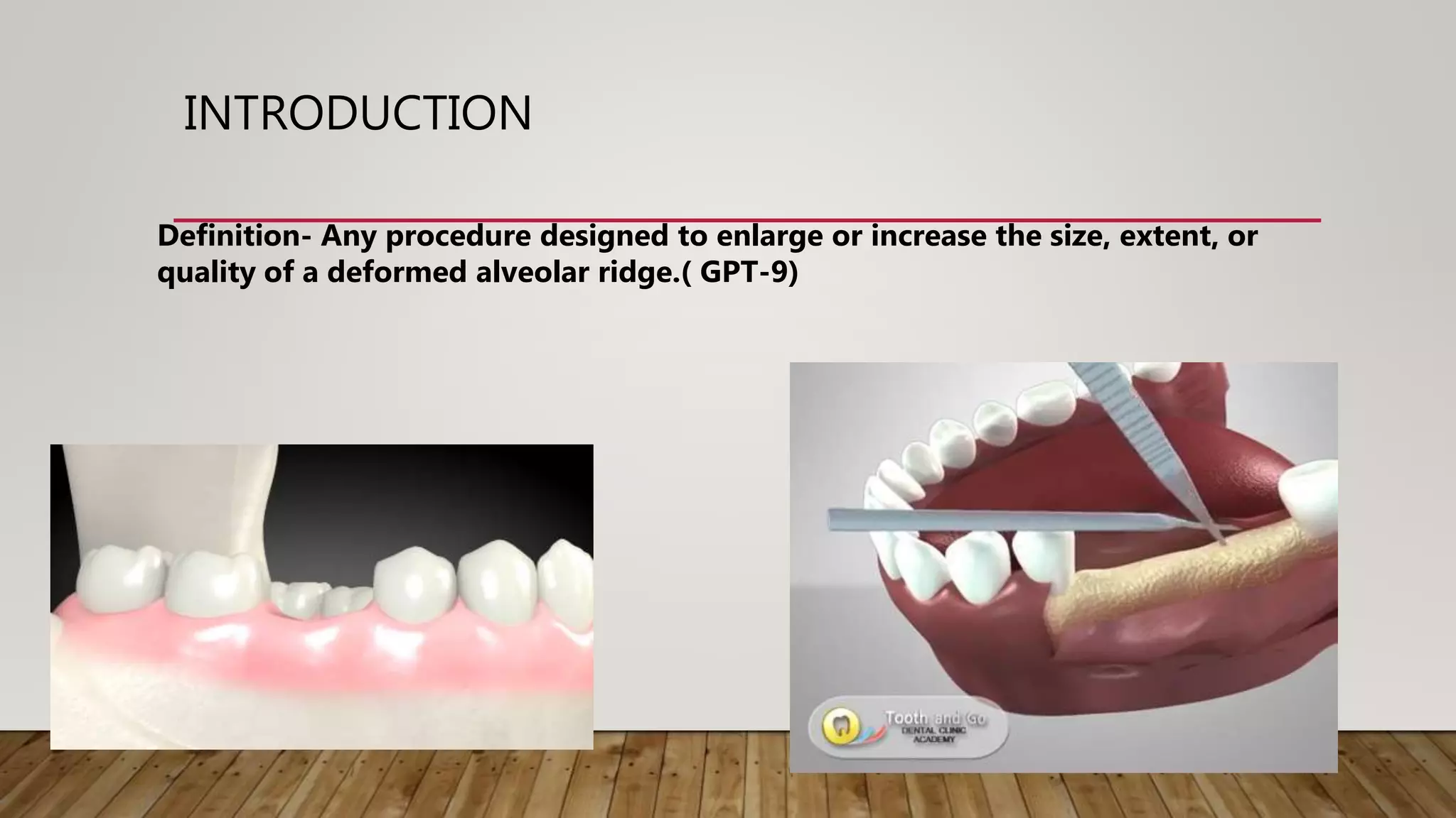 Ridge augmentation seminar | PPTX