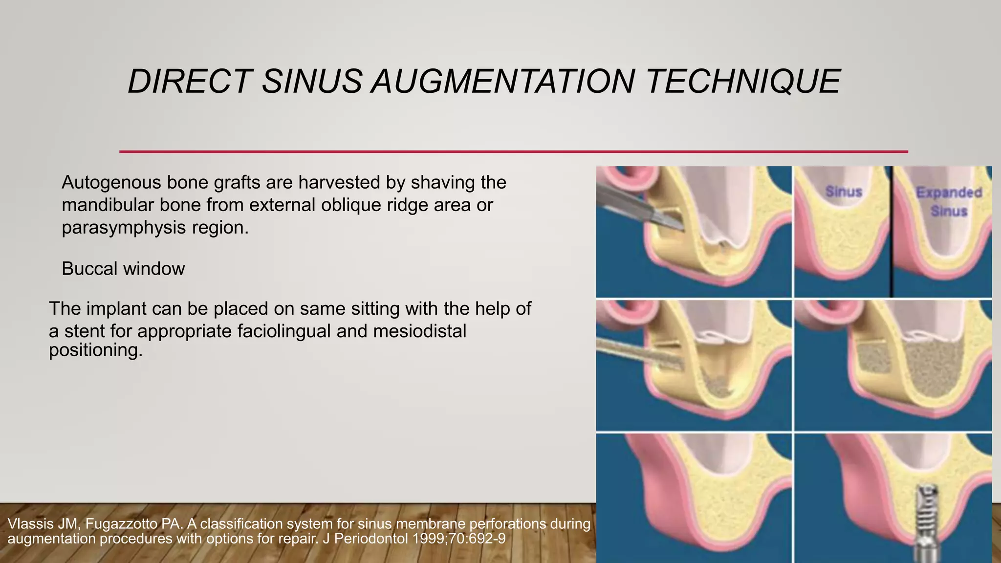 Ridge augmentation seminar | PPTX