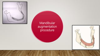 Ridge augmentation seminar | PPTX