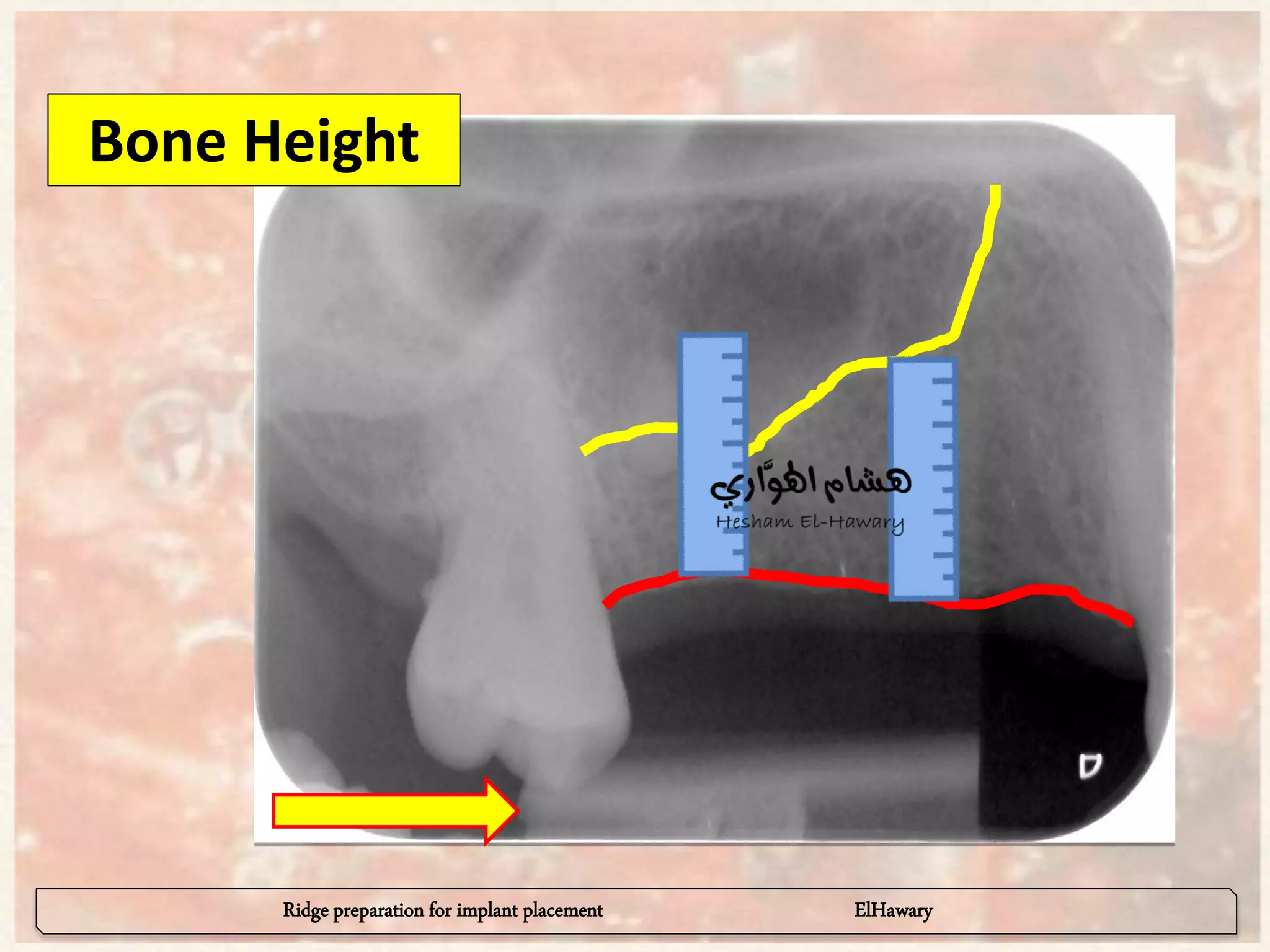 Ridge preparation for implant placement - part 1 | PPTX