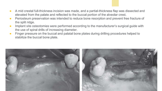 Ridge split in implantology | PPTX | Bone and Joint Conditions ...