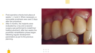 Ridge split in implantology | PPTX