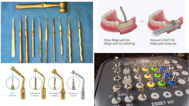 Ridge split in implantology | PPTX | Bone and Joint Conditions ...
