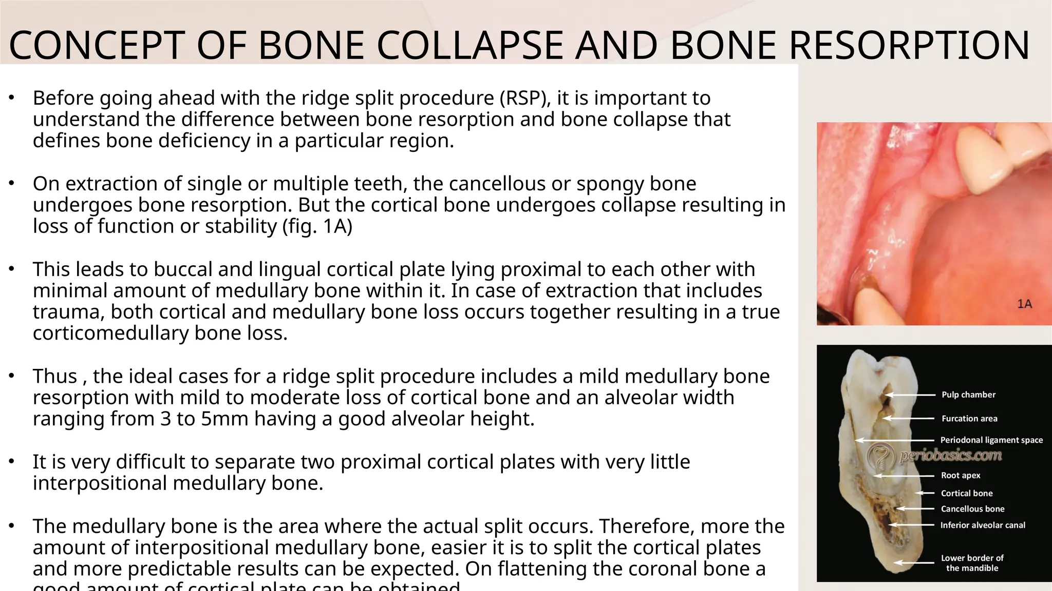Ridge Split Techniques in Prosthodontics: Enhancing Alveolar Ridge for ...