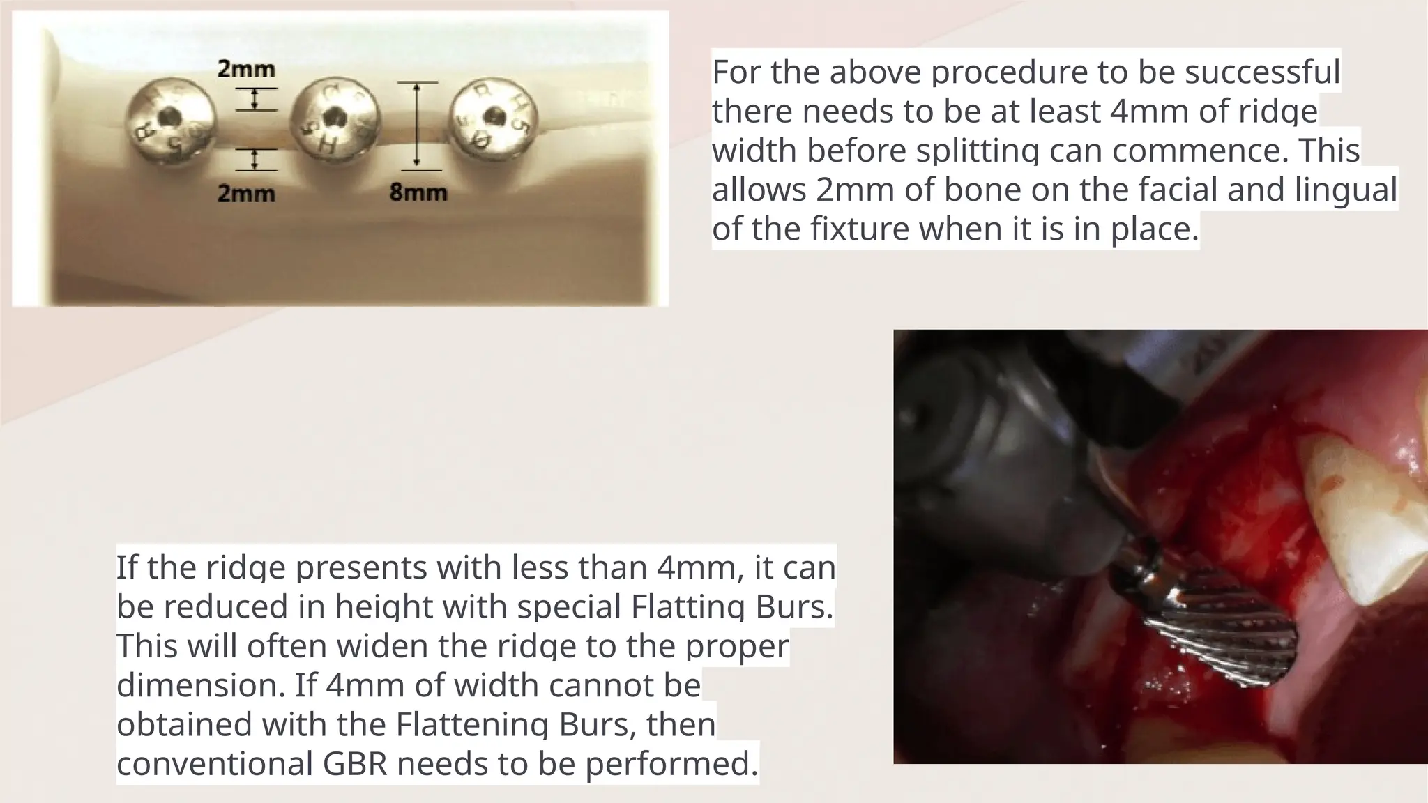 Ridge Split Techniques in Prosthodontics: Enhancing Alveolar Ridge for ...
