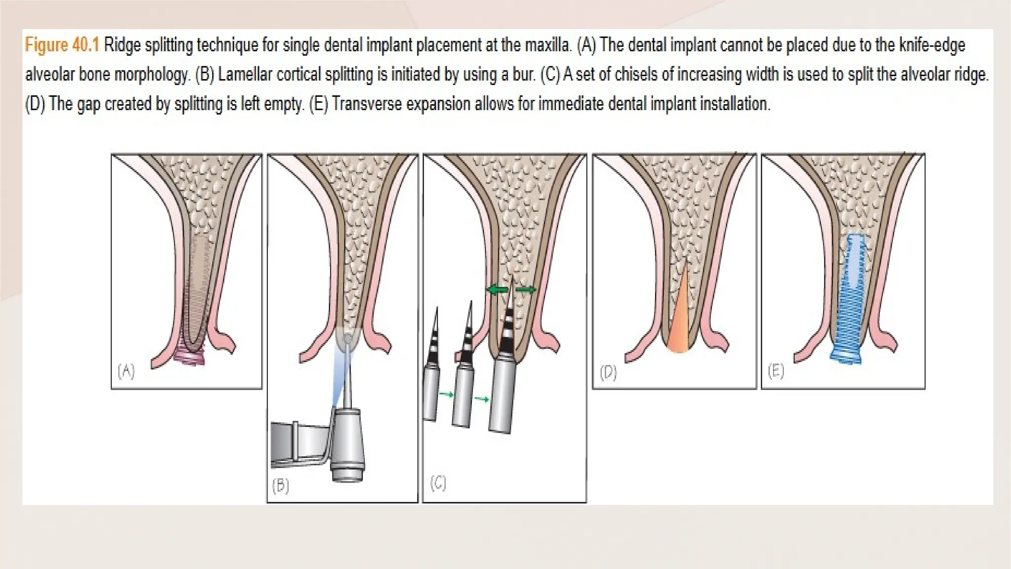 Ridge Split Techniques in Prosthodontics: Enhancing Alveolar Ridge for ...