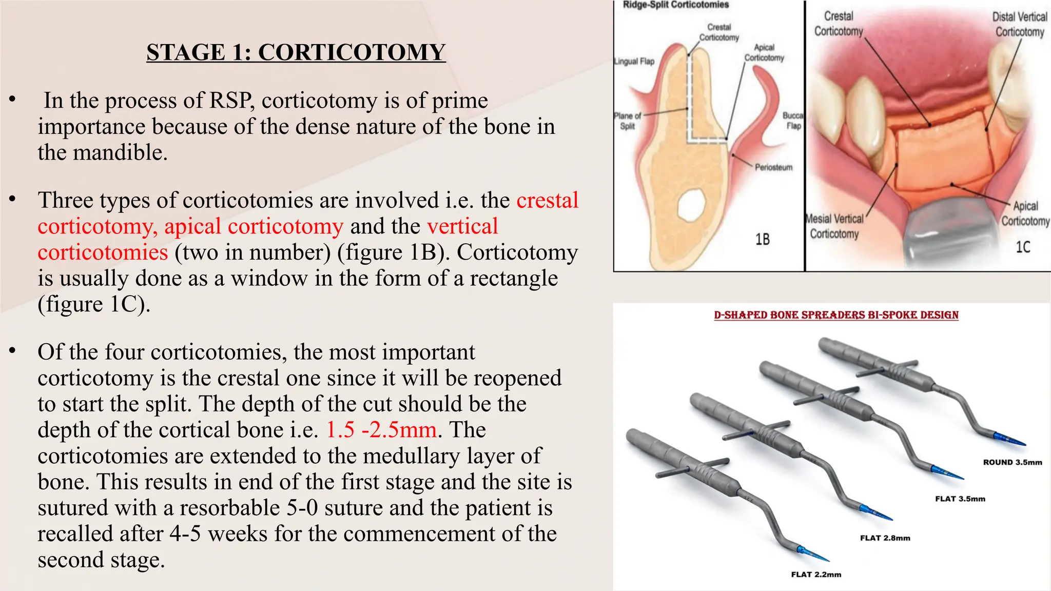 Ridge Split Techniques in Prosthodontics: Enhancing Alveolar Ridge for ...