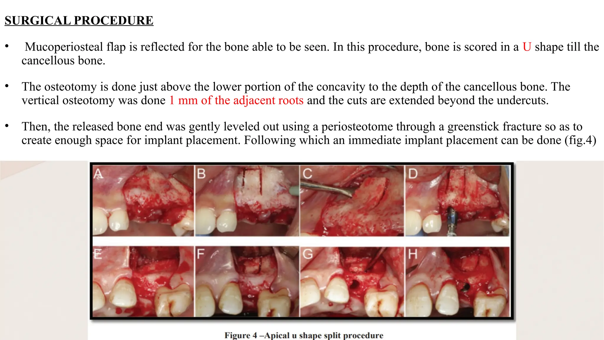 Ridge Split Techniques in Prosthodontics: Enhancing Alveolar Ridge for ...