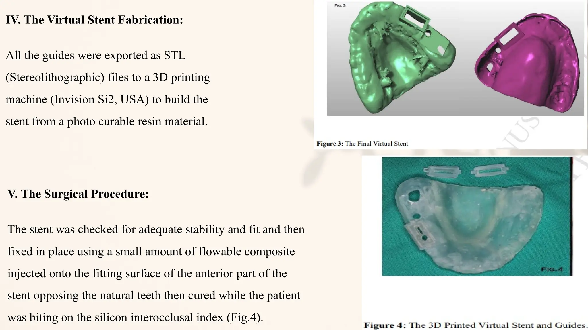 Ridge Split Techniques in Prosthodontics: Enhancing Alveolar Ridge for ...