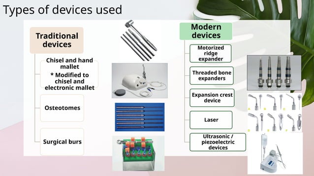 Ridge Split Techniques in Prosthodontics: Enhancing Alveolar Ridge for ...