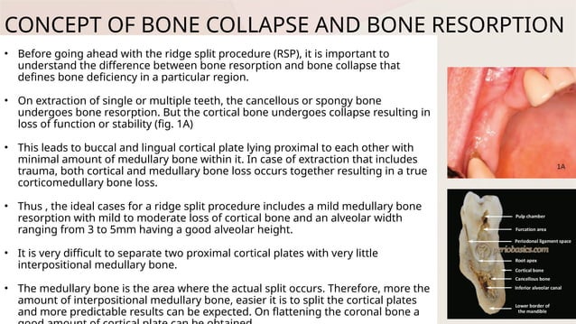 Ridge Split Techniques in Prosthodontics: Enhancing Alveolar Ridge for ...
