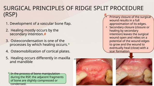 Ridge Split Techniques in Prosthodontics: Enhancing Alveolar Ridge for ...