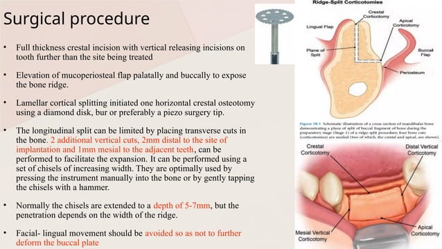 Ridge Split Techniques in Prosthodontics: Enhancing Alveolar Ridge for ...