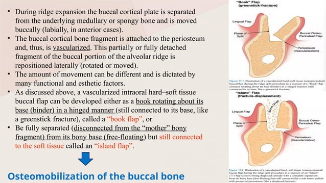 Ridge Split Techniques in Prosthodontics: Enhancing Alveolar Ridge for ...