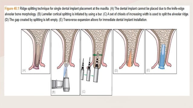 Ridge Split Techniques in Prosthodontics: Enhancing Alveolar Ridge for ...