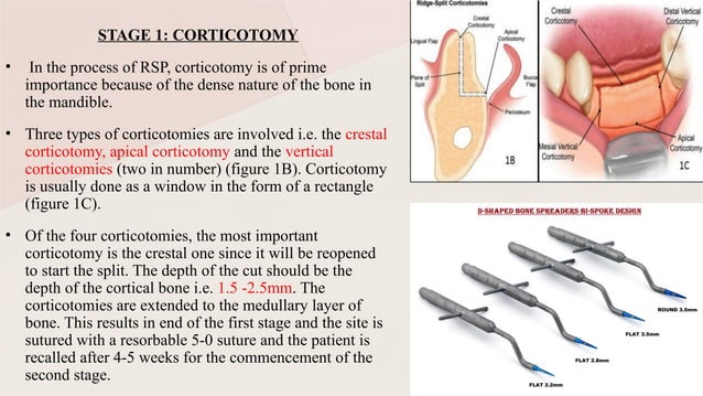 Ridge Split Techniques in Prosthodontics: Enhancing Alveolar Ridge for ...