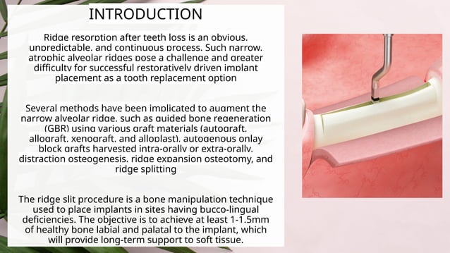 Ridge Split Techniques in Prosthodontics: Enhancing Alveolar Ridge for ...