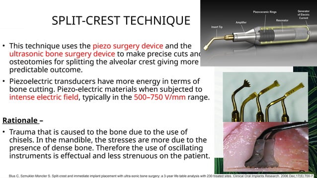 Ridge Split Techniques in Prosthodontics: Enhancing Alveolar Ridge for ...