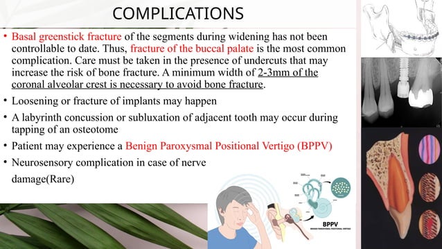 Ridge Split Techniques in Prosthodontics: Enhancing Alveolar Ridge for ...